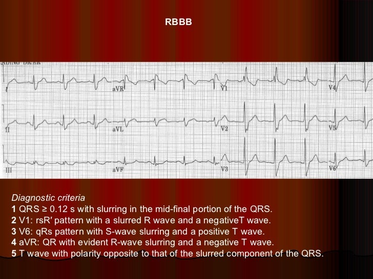 Ecg 2