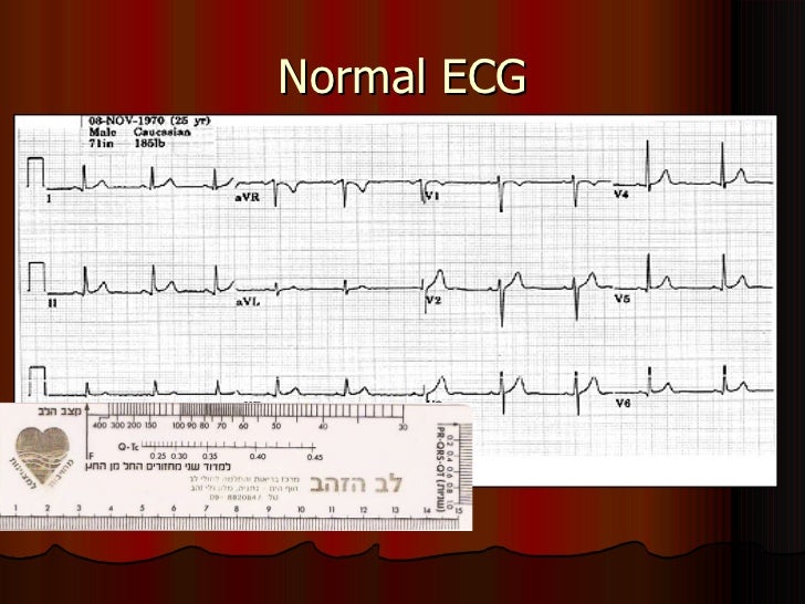 Ecg 2