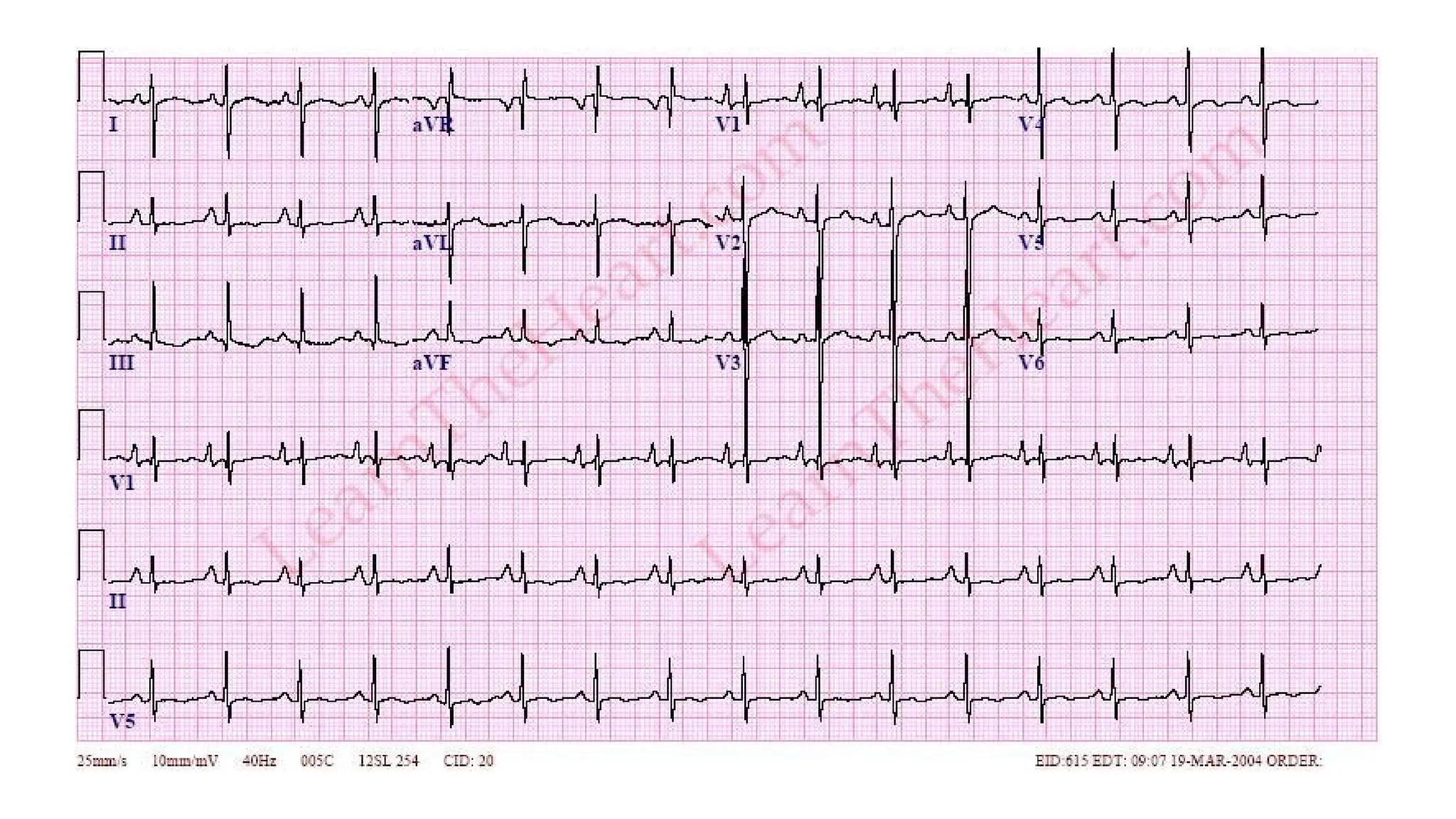 basics of ecg to whuch is physiology of ecg plus the b | PPT