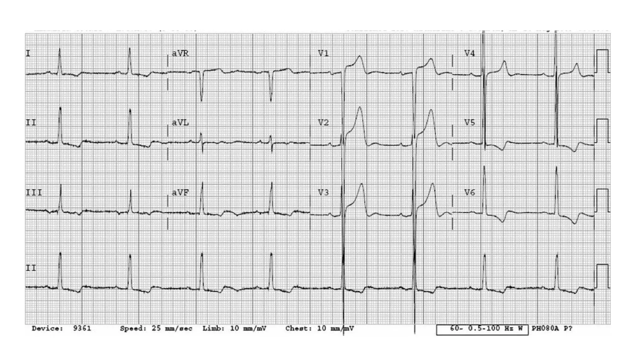 basics of ecg to whuch is physiology of ecg plus the b | PPT