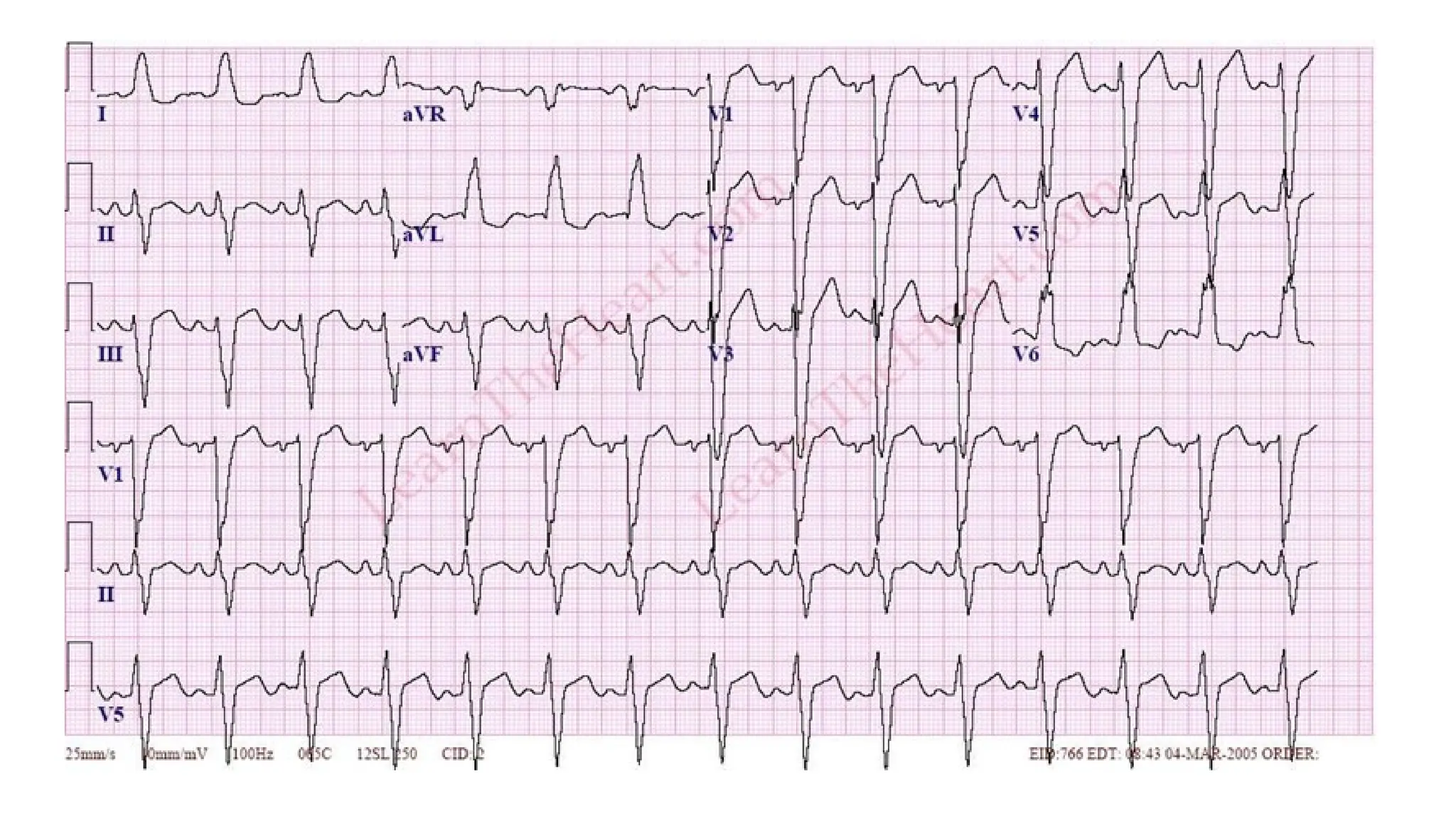 basics of ecg to whuch is physiology of ecg plus the b | PPT