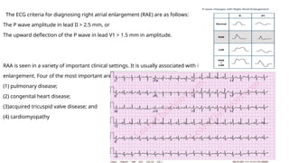 basics of ecg to whuch is physiology of ecg plus the b | PPT
