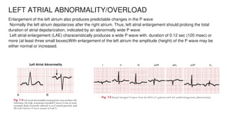basics of ecg to whuch is physiology of ecg plus the b | PPT