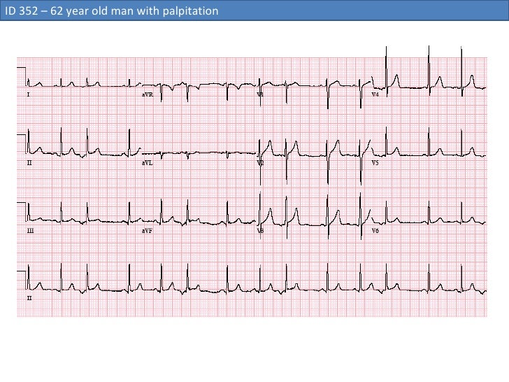 Premature Atrial Complexes
