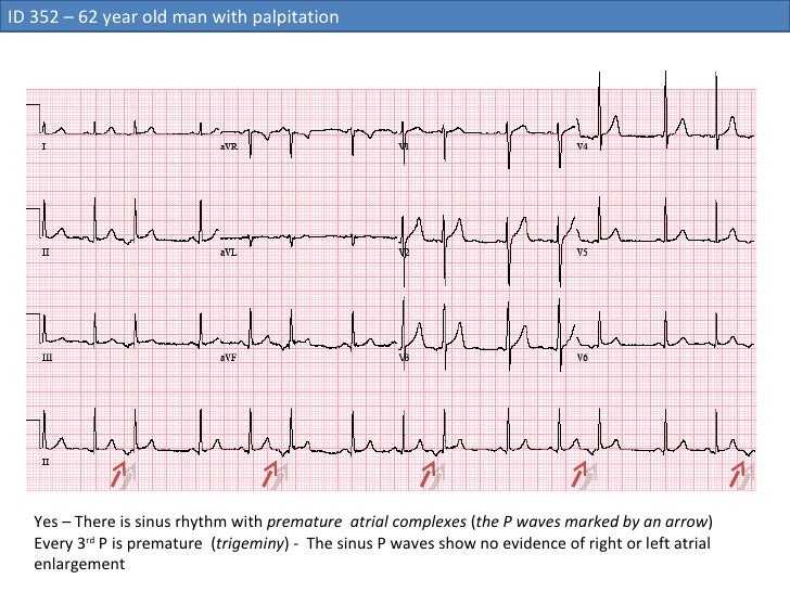 ECG #2 - ID 352 - Premature Atrial Complexes