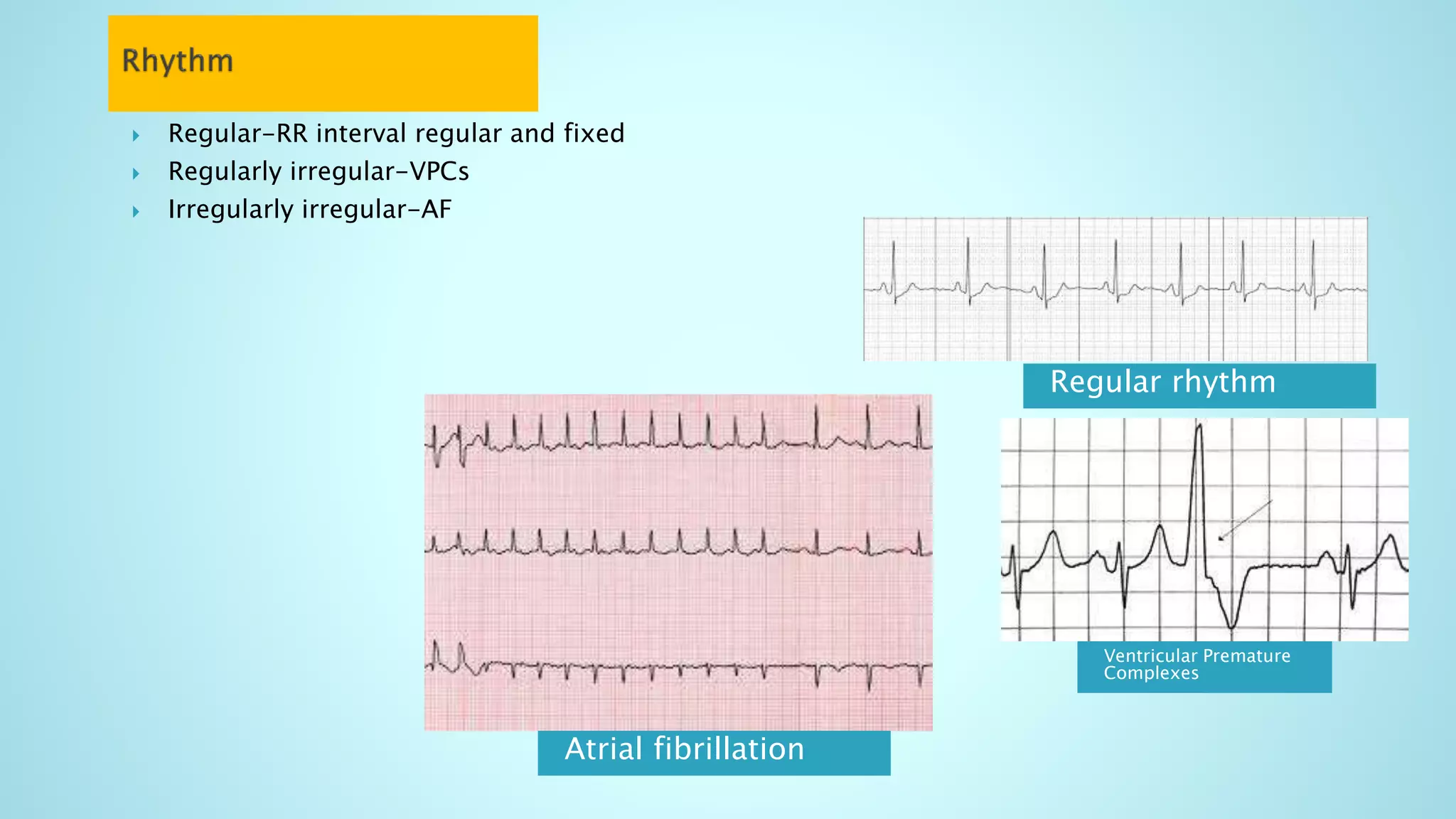 Ecg for beginners | PPTX