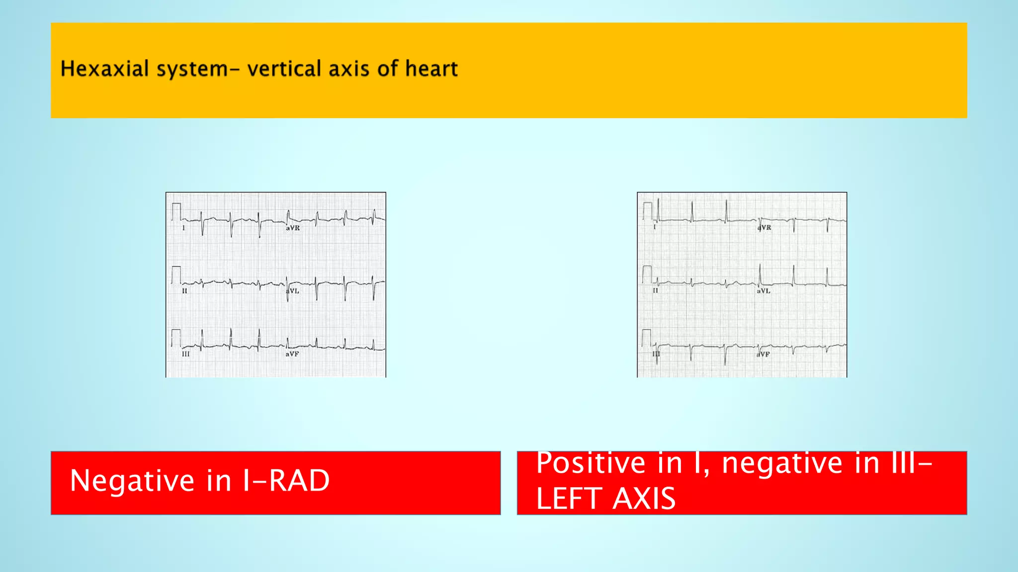 Ecg for beginners | PPTX