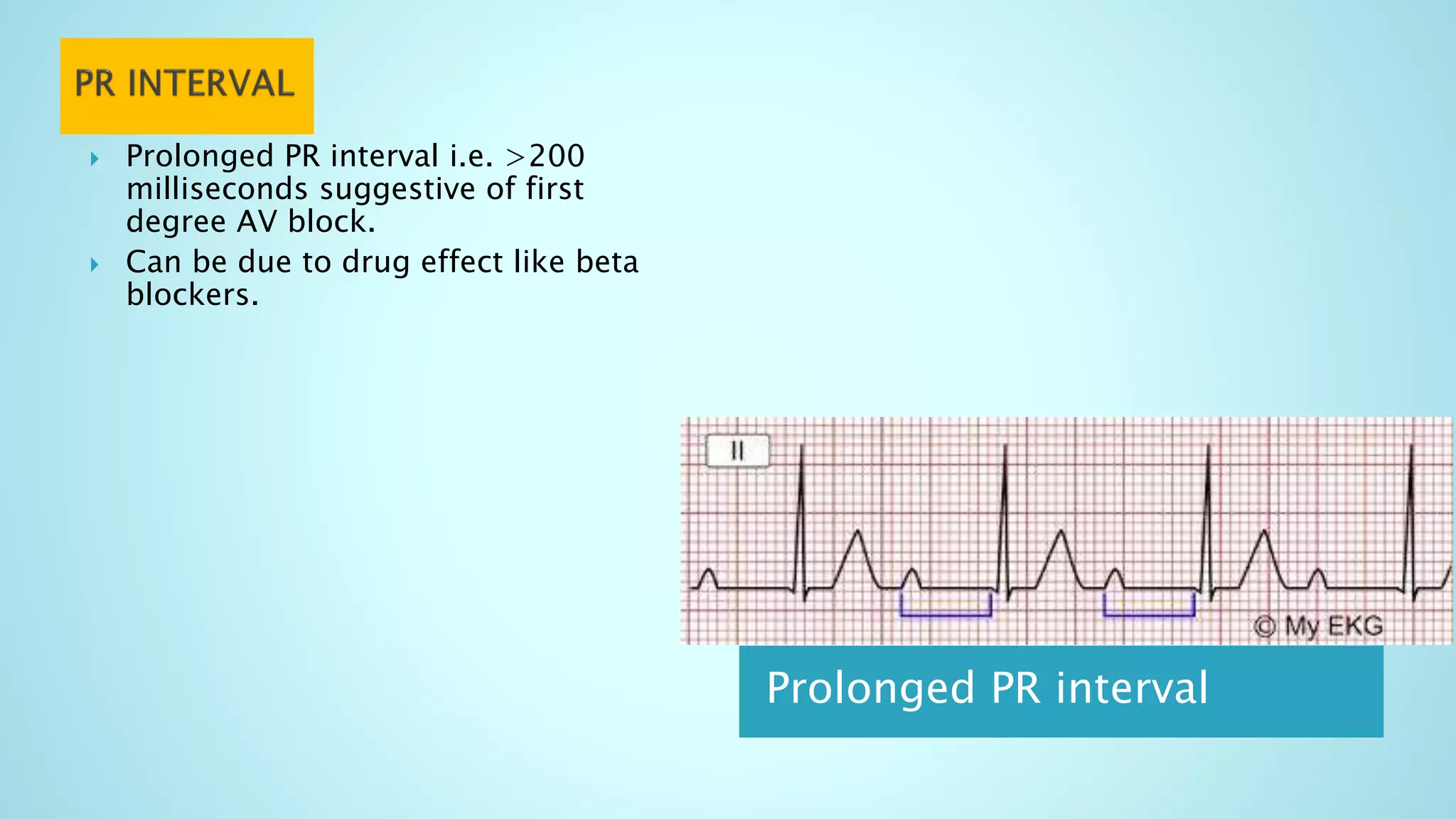 Ecg for beginners | PPTX