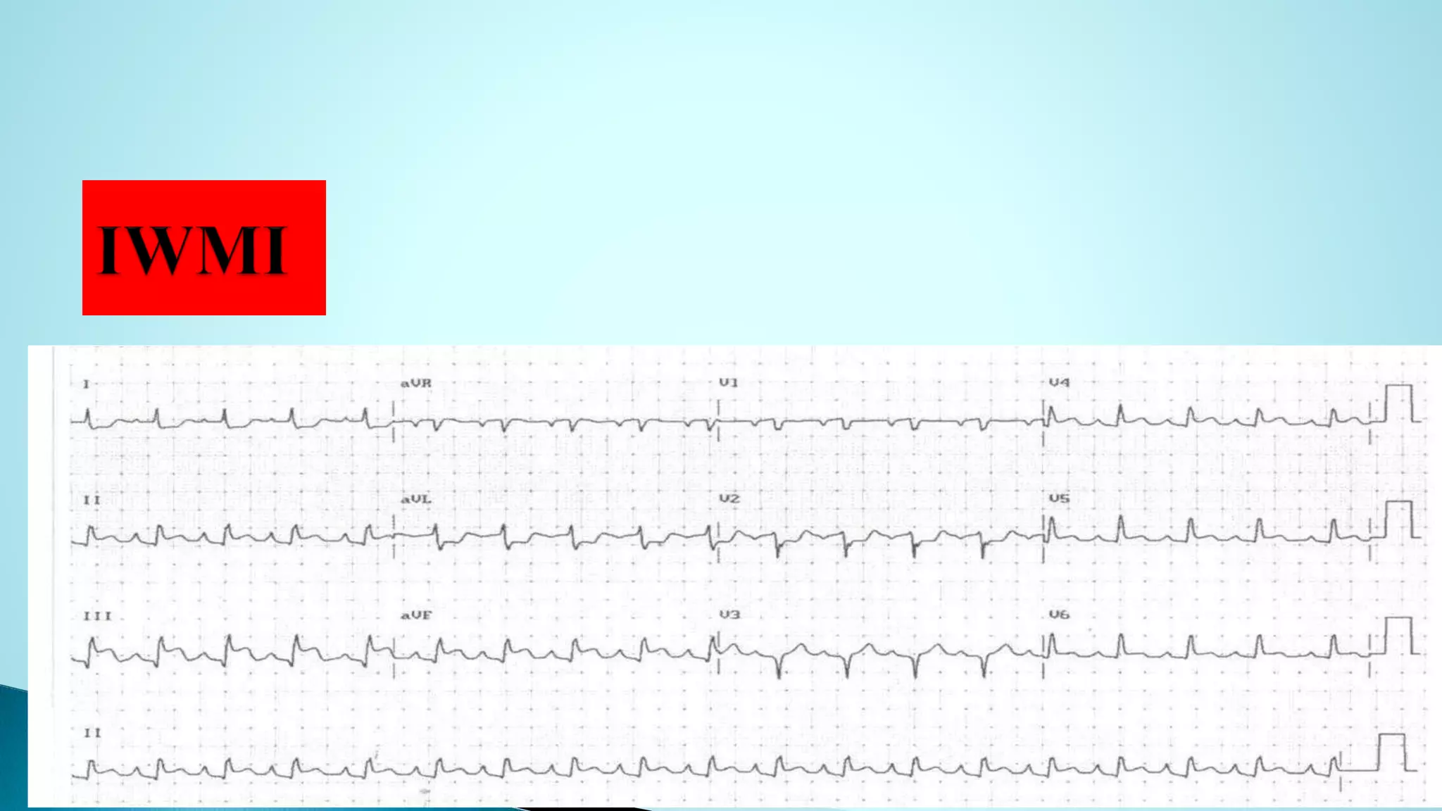 Ecg for beginners | PPTX