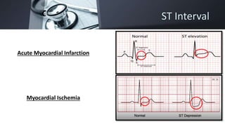 Ecg | PPT