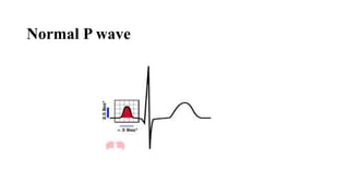 Ecg | PPT