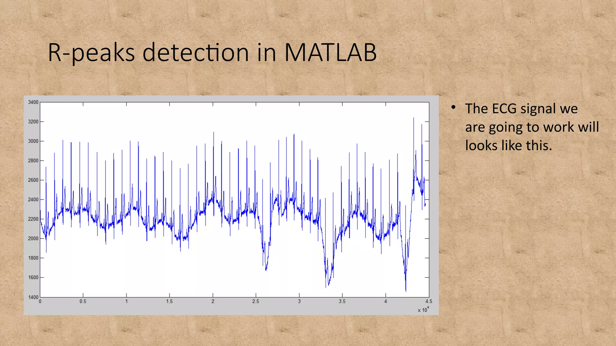 Ecg R Peak Detection | PDF