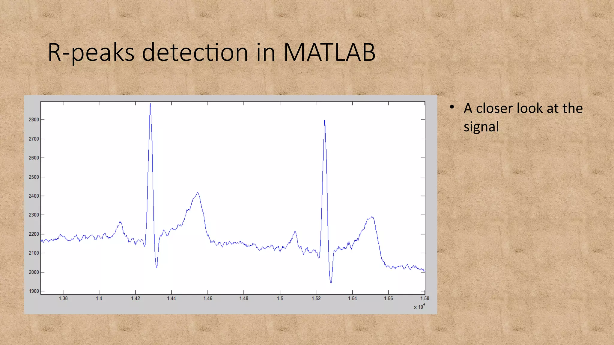 Ecg R Peak Detection | PDF