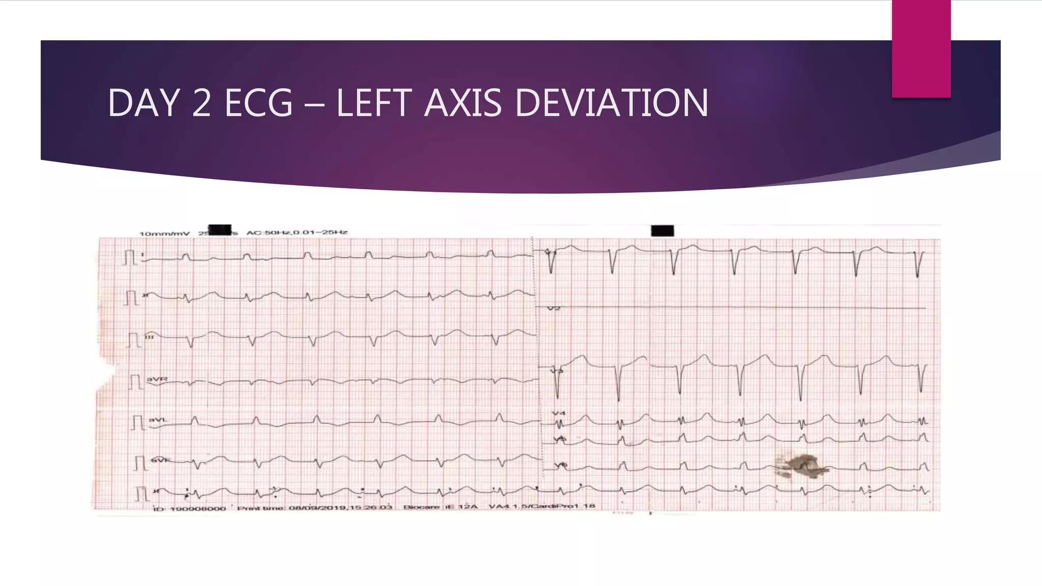 ECG BASICS | PPT