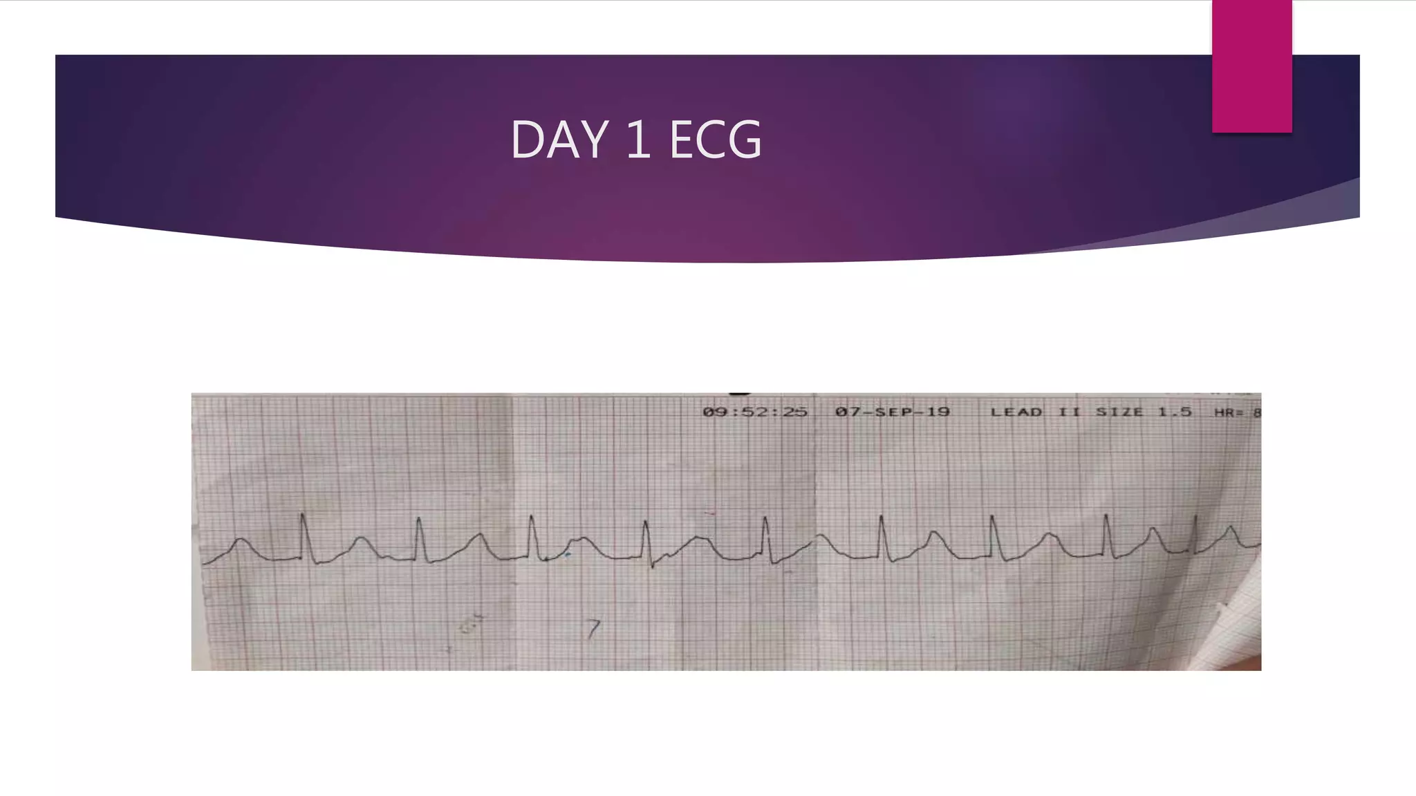 ECG BASICS | PPT