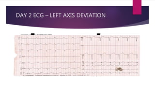 ECG BASICS | PPTX
