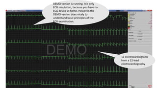 ECG | PDF | Heart and Cardiovascular Diseases | Diseases and Conditions