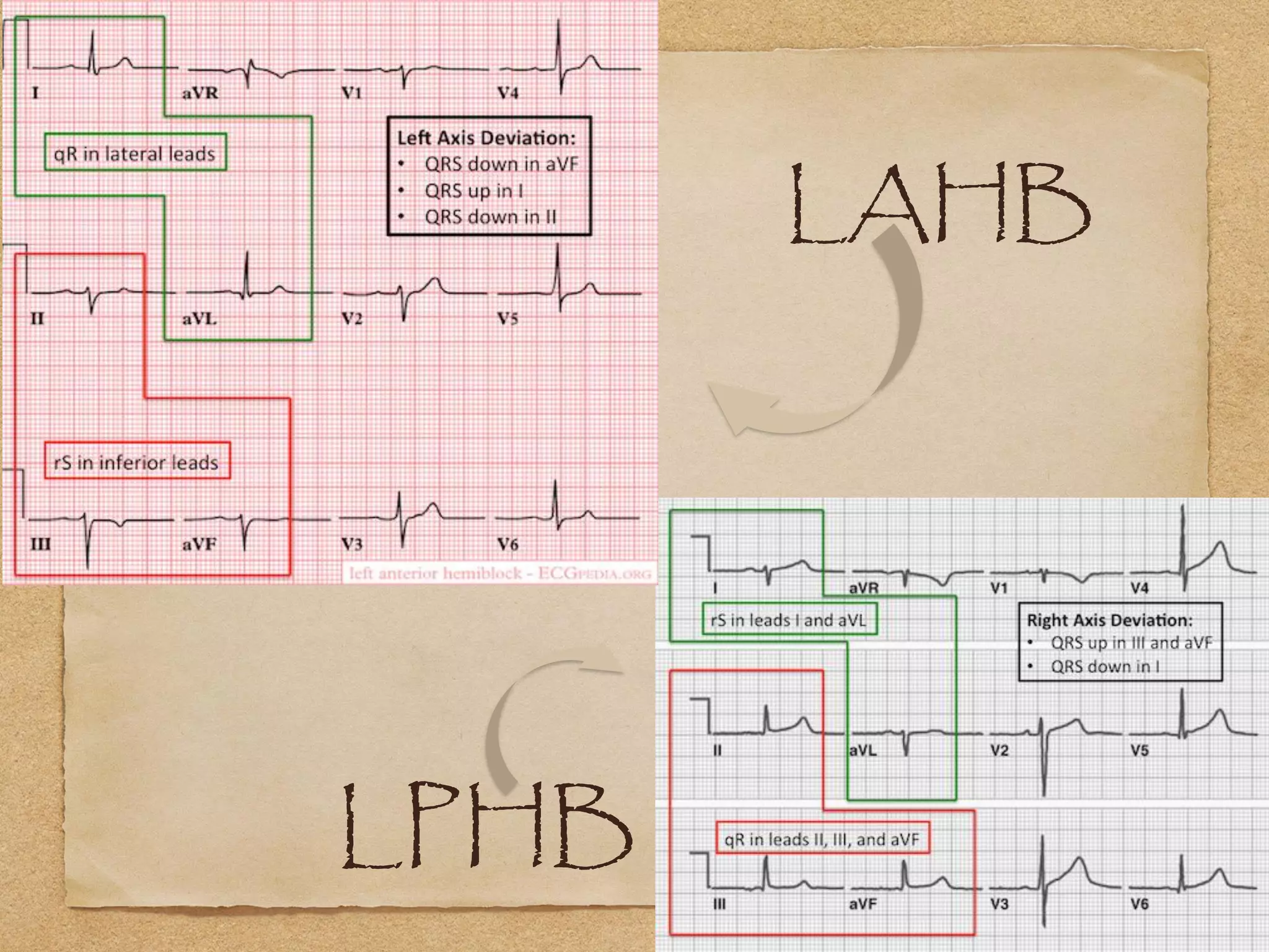 ECG Interpretation | PDF