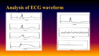 ECG-Electrocardiography | PPT