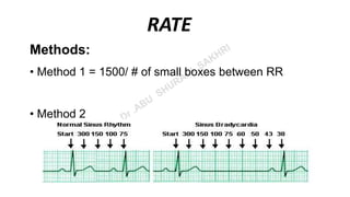 ECG ( Electrocardiogram) | PPT