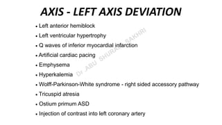 ECG ( Electrocardiogram) | PPT