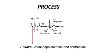 ECG ( Electrocardiogram) | PPT