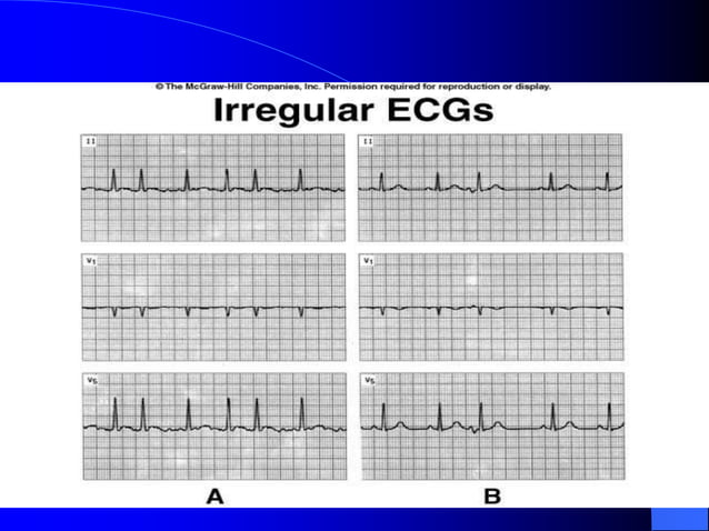 Ecg | PPT