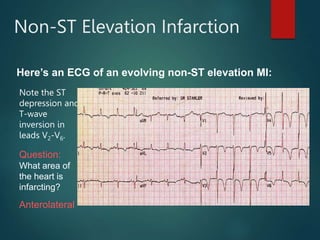 ECG | PPT