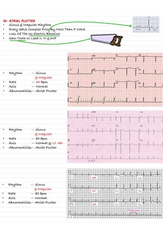 شرح جميع حالات ال ECG⁩.pdf