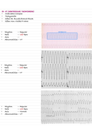 شرح جميع حالات ال ECG⁩.pdf