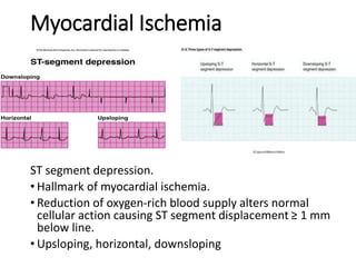 ECG complete lecture presentation, ECG waveform and leads placement | PPTX