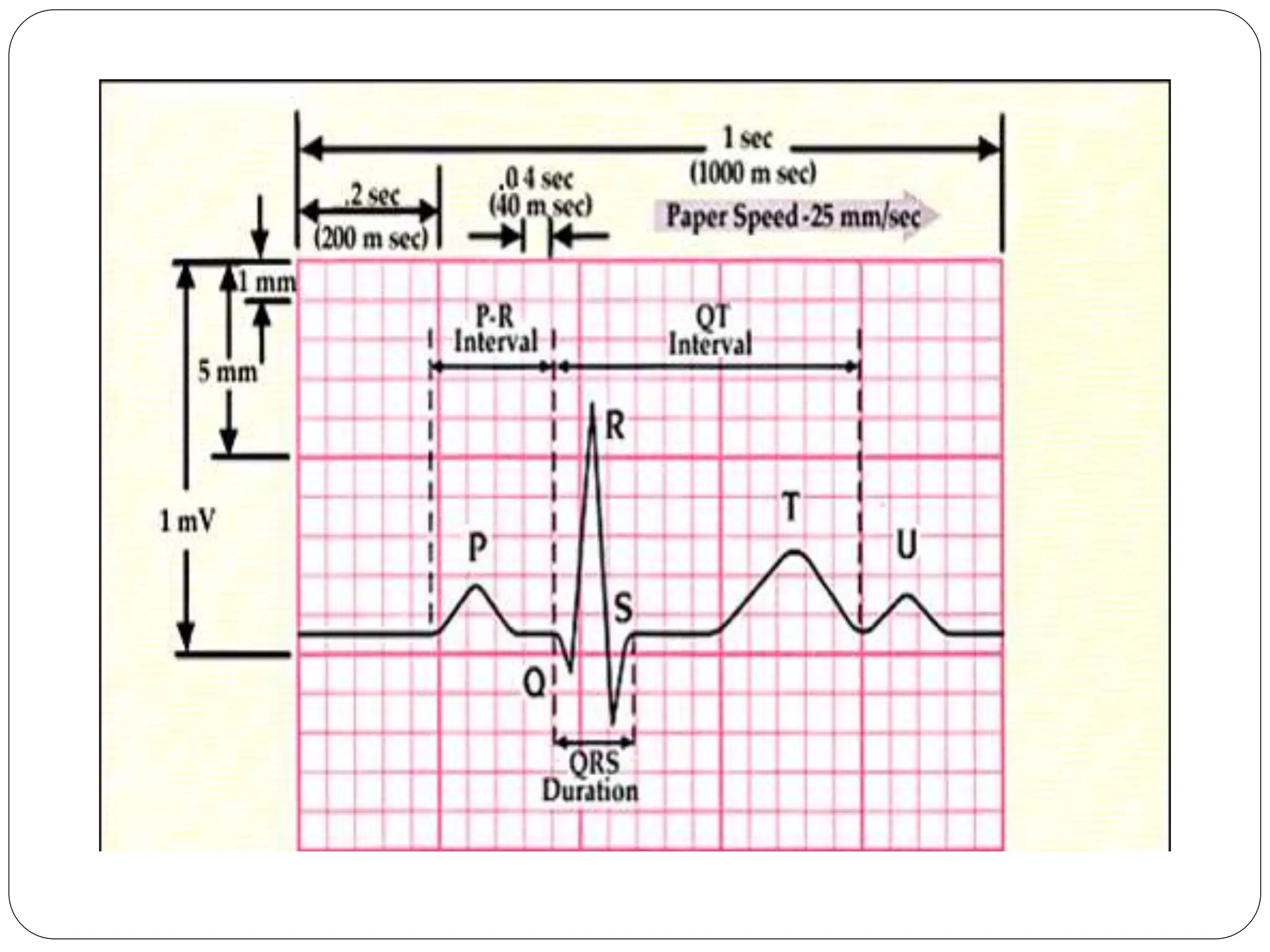 Electrocardiogram (ECG or EKG) - Learn With Sonam | PPT