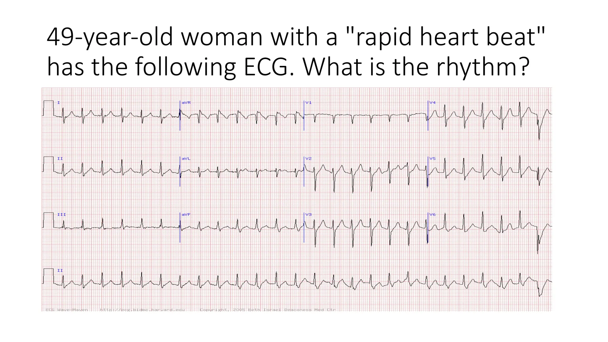 Electrocardiogram (ECG) case studies.pptx