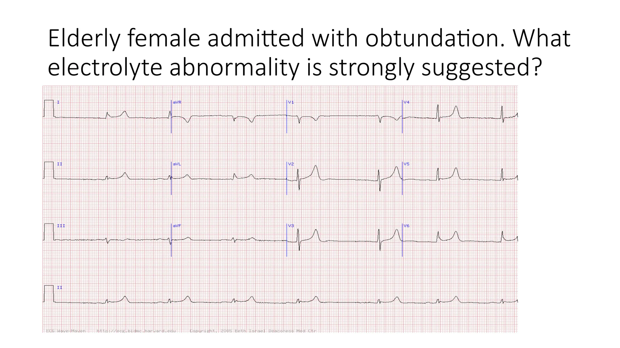 Electrocardiogram (ECG) case studies.pptx