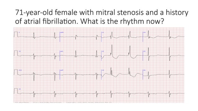 Electrocardiogram (ECG) case studies.pptx