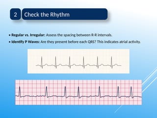 ECG Interpretation for nurses A Step-by-Step Guide to Analyze ECG Rhythms .pptx