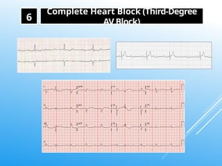 ECG Interpretation for nurses A Step-by-Step Guide to Analyze ECG Rhythms .pptx