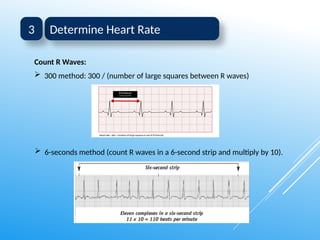 ECG Interpretation for nurses A Step-by-Step Guide to Analyze ECG ...