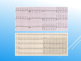 ECG Interpretation for nurses A Step-by-Step Guide to Analyze ECG ...
