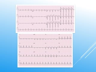 ECG Interpretation for nurses A Step-by-Step Guide to Analyze ECG ...