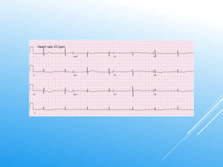 ECG Interpretation for nurses A Step-by-Step Guide to Analyze ECG ...