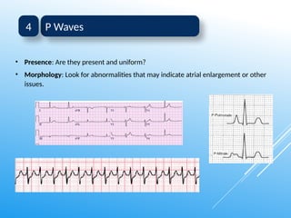 ECG Interpretation for nurses A Step-by-Step Guide to Analyze ECG ...
