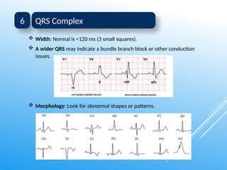 ECG, Mastering ECG Interpretation For Nurses.pptx