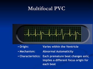 Ecg 3 | PPT