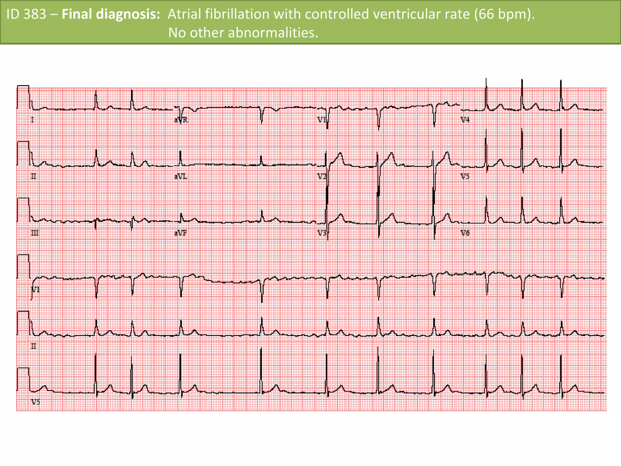 ECG #4 - ID 383 – Atrial fibrillation | PPT