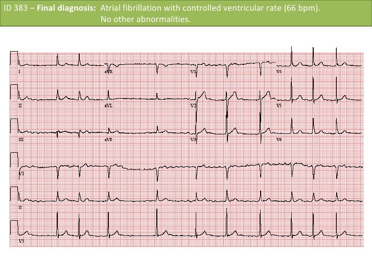 ECG #4 - ID 383 – Atrial fibrillation