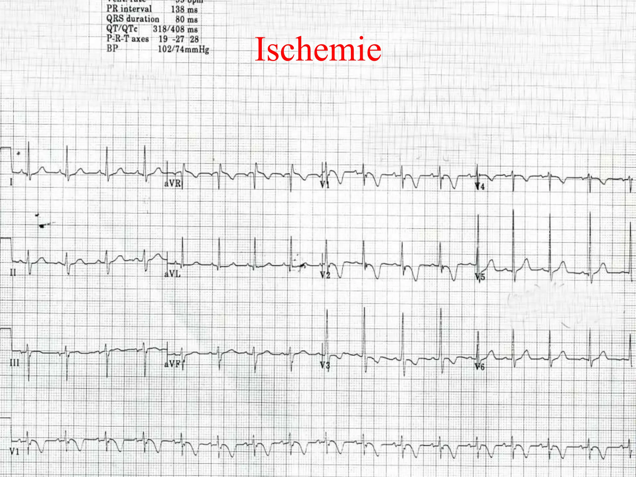 ECG-5-2016-2017-Ischemie-leziune-infacrct.ppt