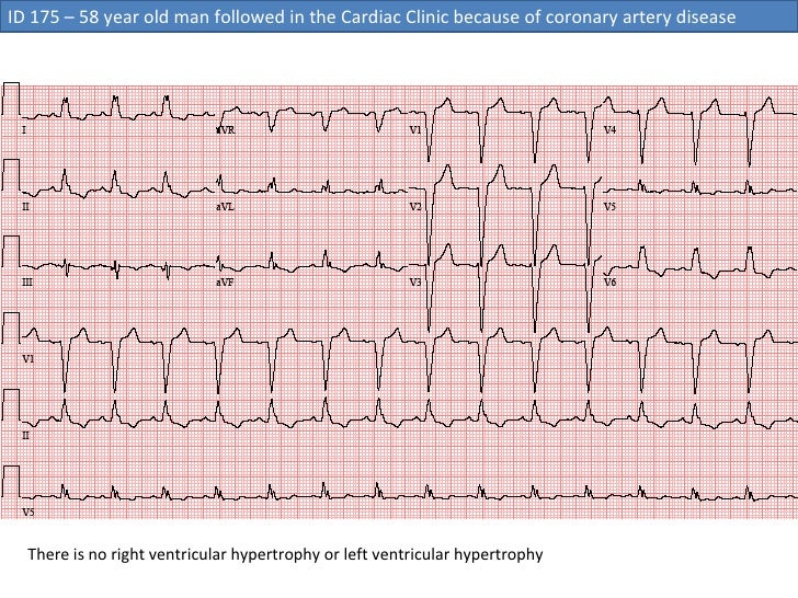 ECG #5 - ID 168 - Left bundle branch block