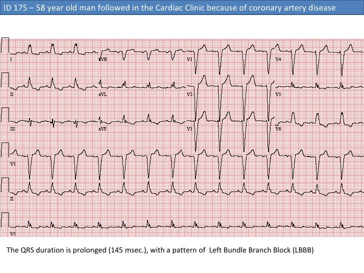 ECG #5 - ID 168 - Left bundle branch block