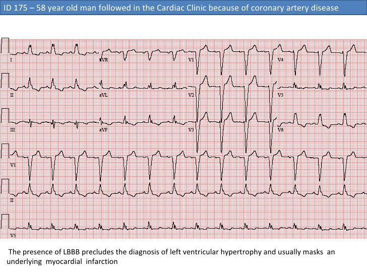 ECG #5 - ID 168 - Left bundle branch block